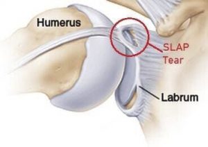What is SLAP lesion